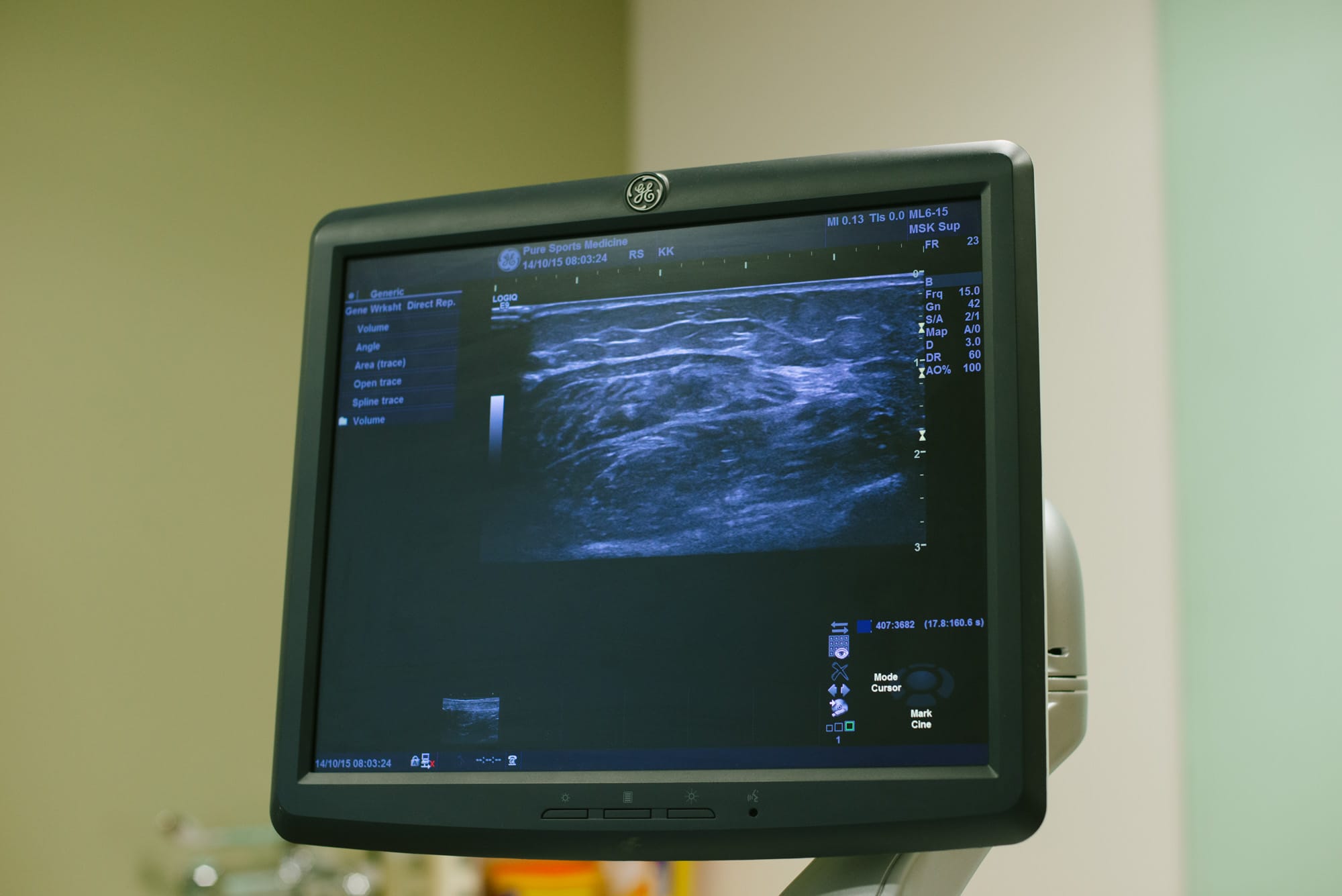 Ultrasound for Pelvic Health - Pure Sports Medicine